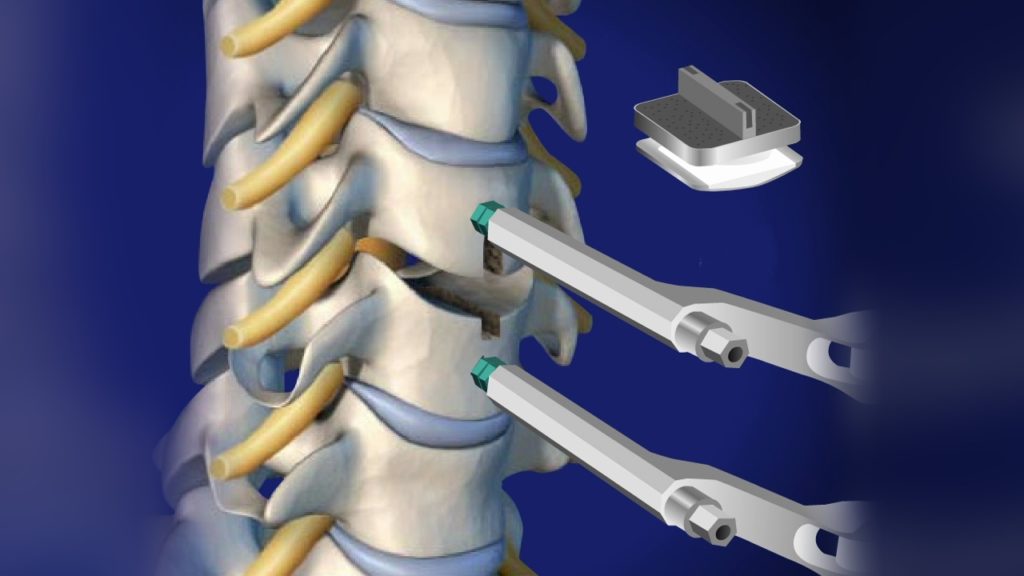 Your Guide to Artificial Disk Replacement – Cascade Medical Boutique